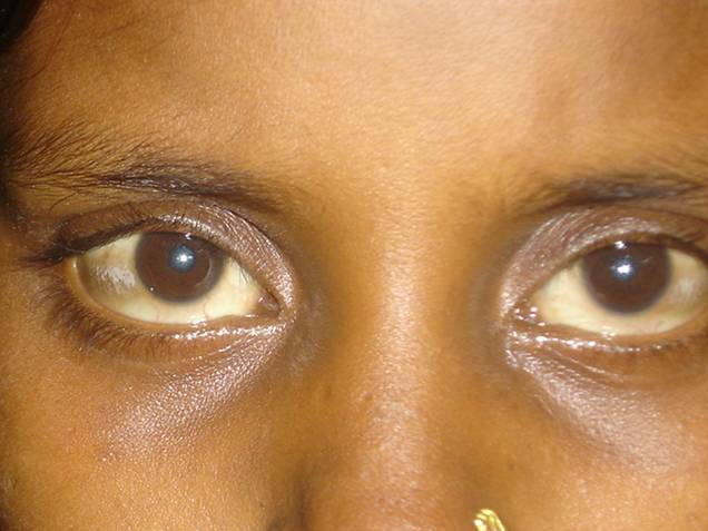 Bantra St. Thomas' Home Welfare Society | An adolescent with Bitot`s spots