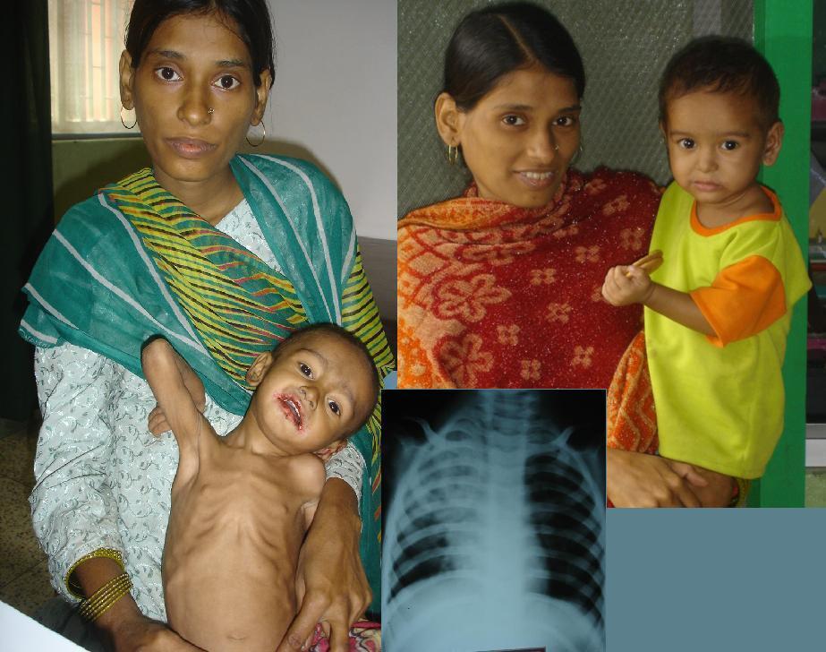 Bantra St. Thomas' Home Welfare Society | Tuberculosis Treatment Before ...